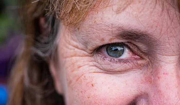 The Ultimate Guide to Getting Rid of Wrinkles Around Eyes When Smiling ...